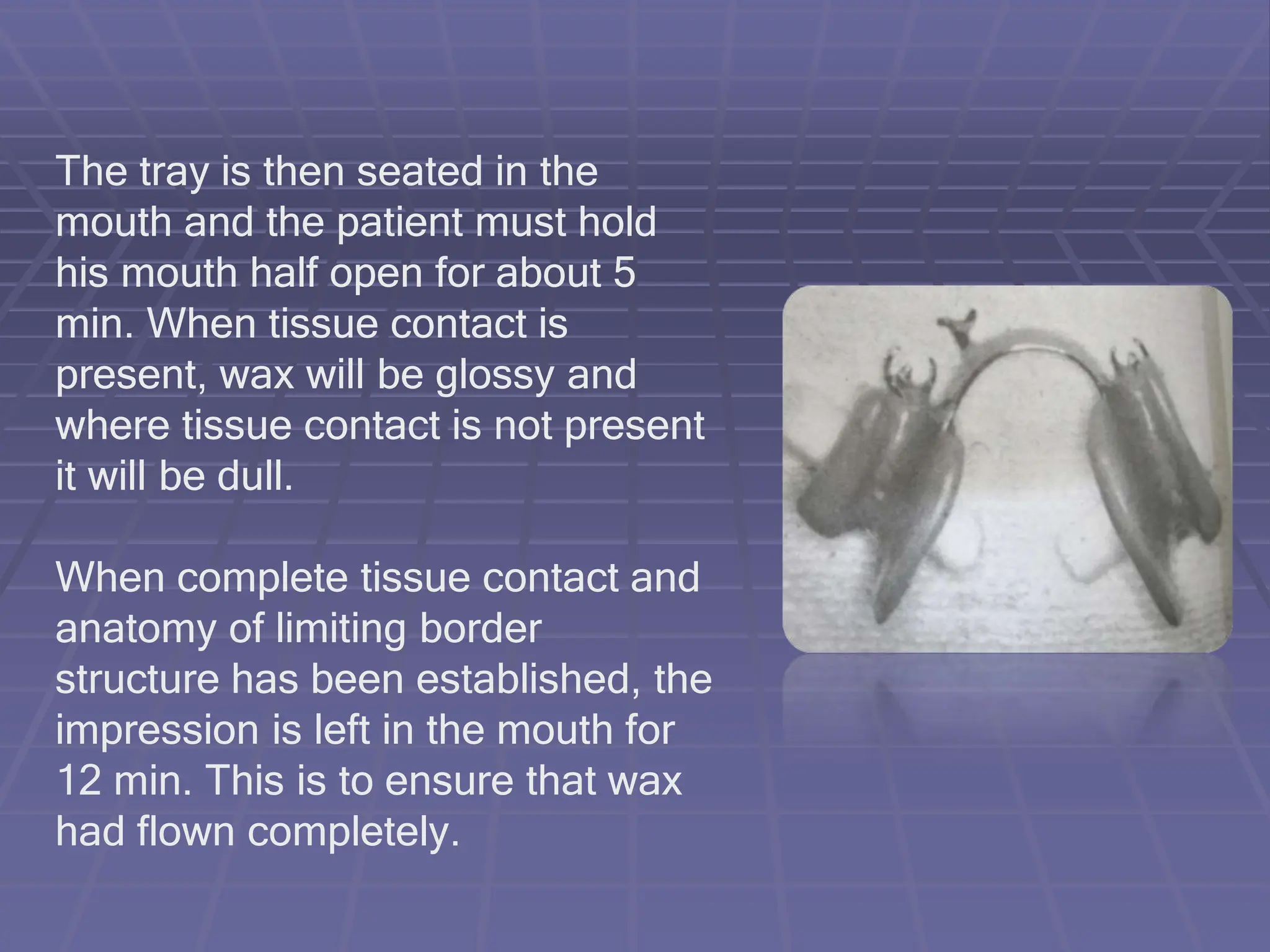 Impression Procedure for RPD’s- mandy.ppt