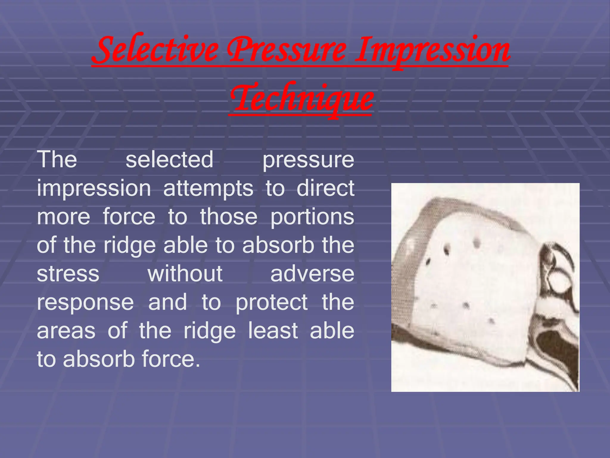 Impression Procedure for RPD’s- mandy.ppt