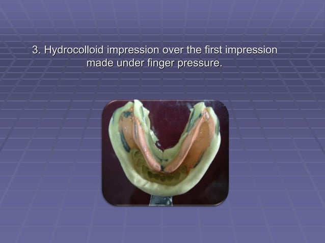 Impression Procedure for RPD’s- mandy.ppt