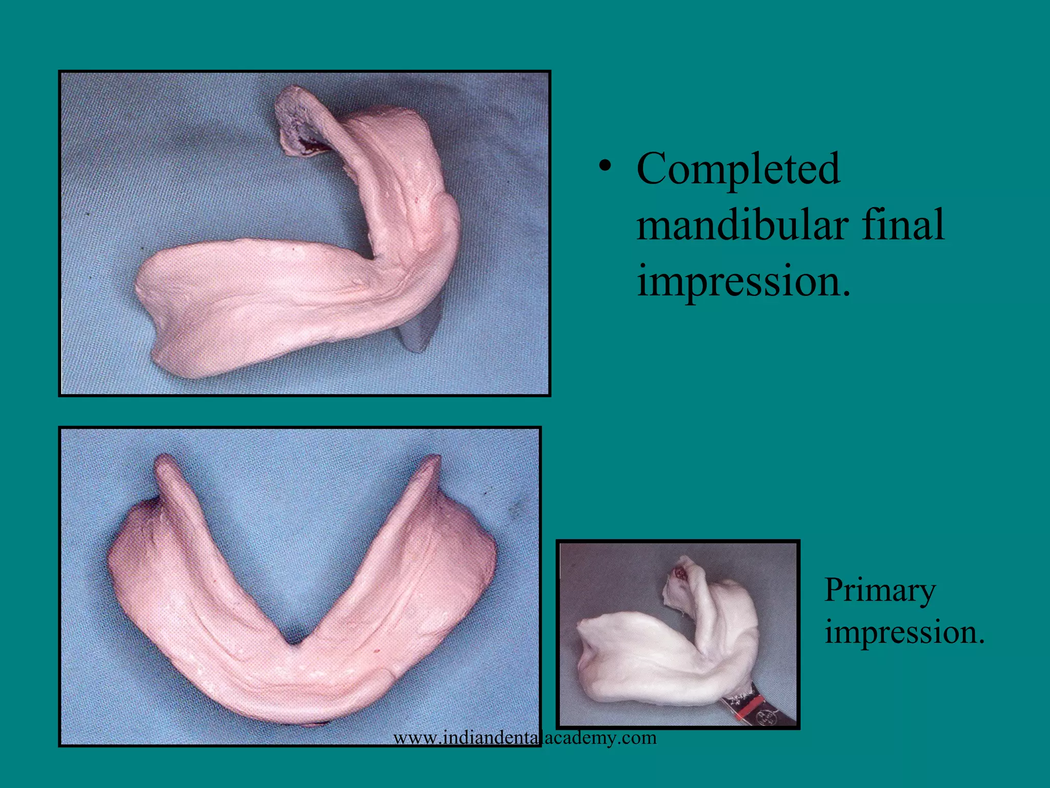 Impression procedures comlete denture/dental courses | PPT