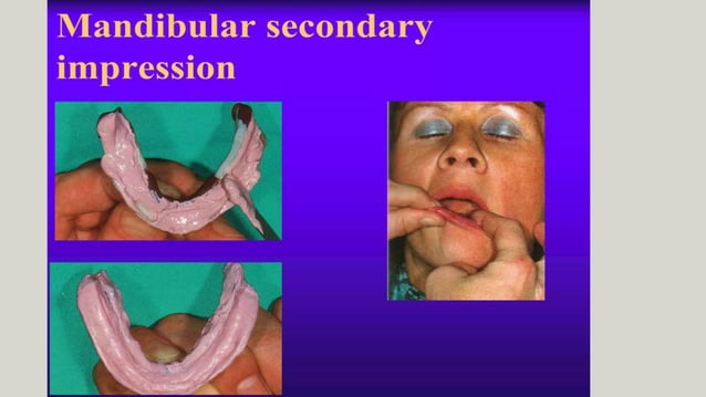 IMPRESSION PROCEDURES FOR COMPLETE DENTURES.pptx