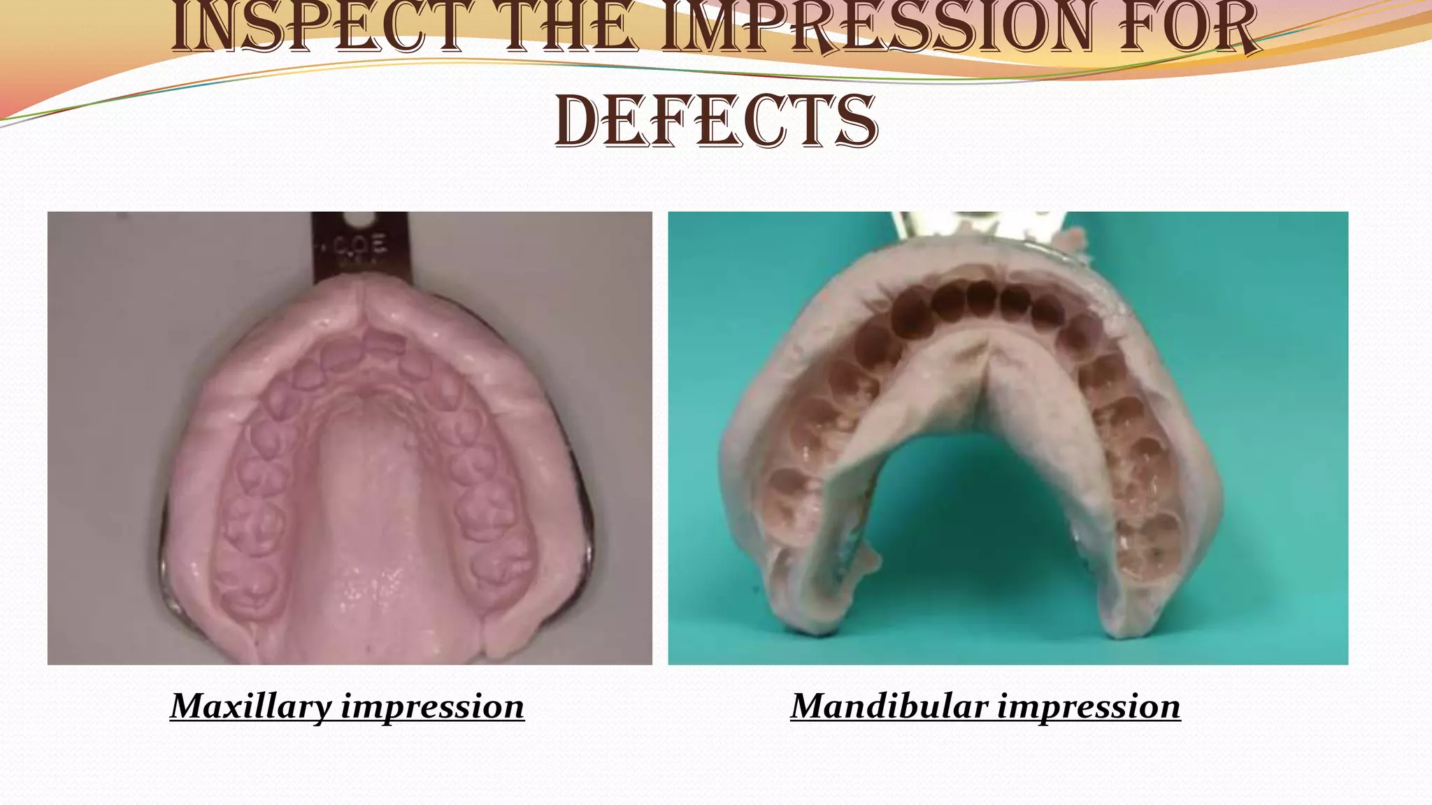 Impression procedures for removable partial denture | PPTX