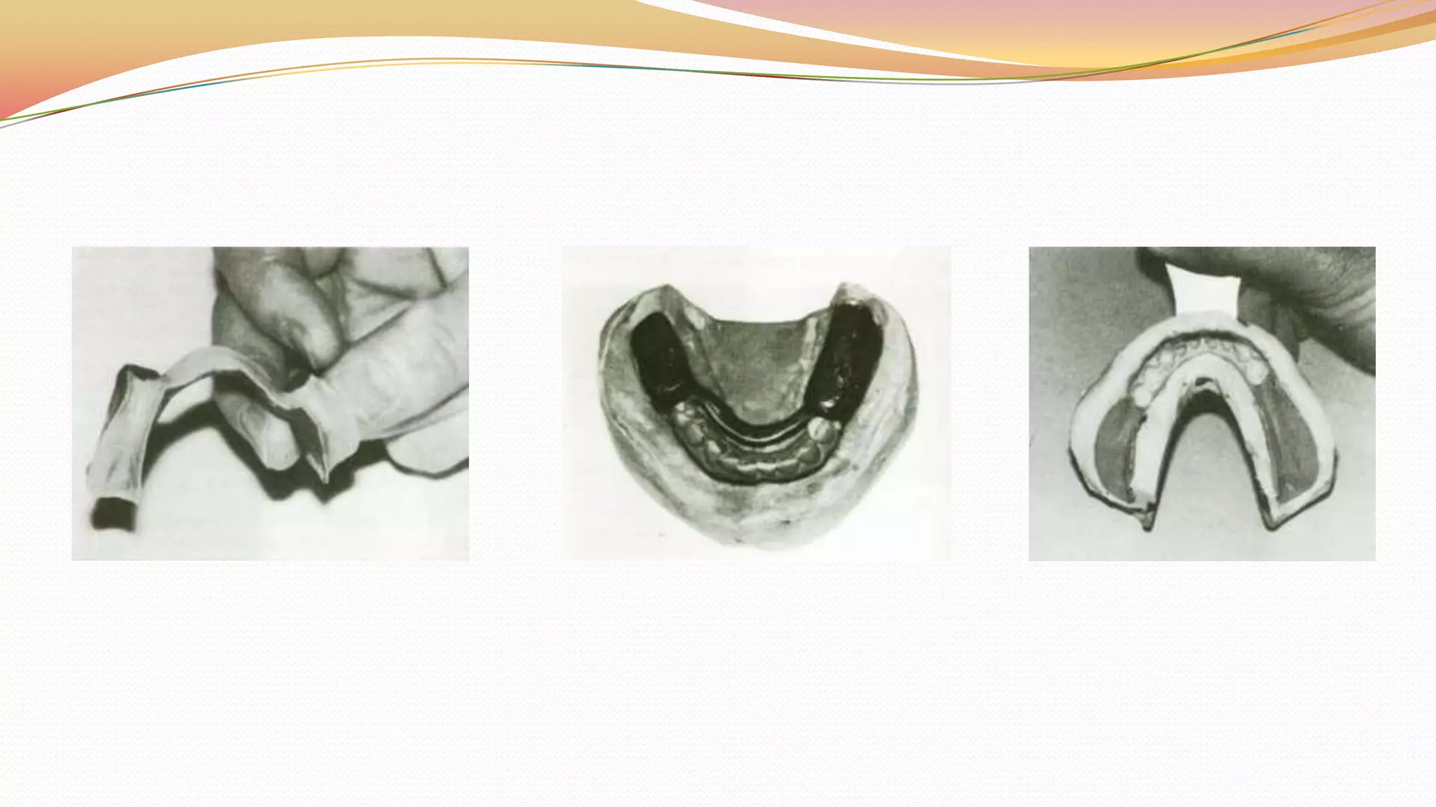 Impression procedures for removable partial denture | PPTX