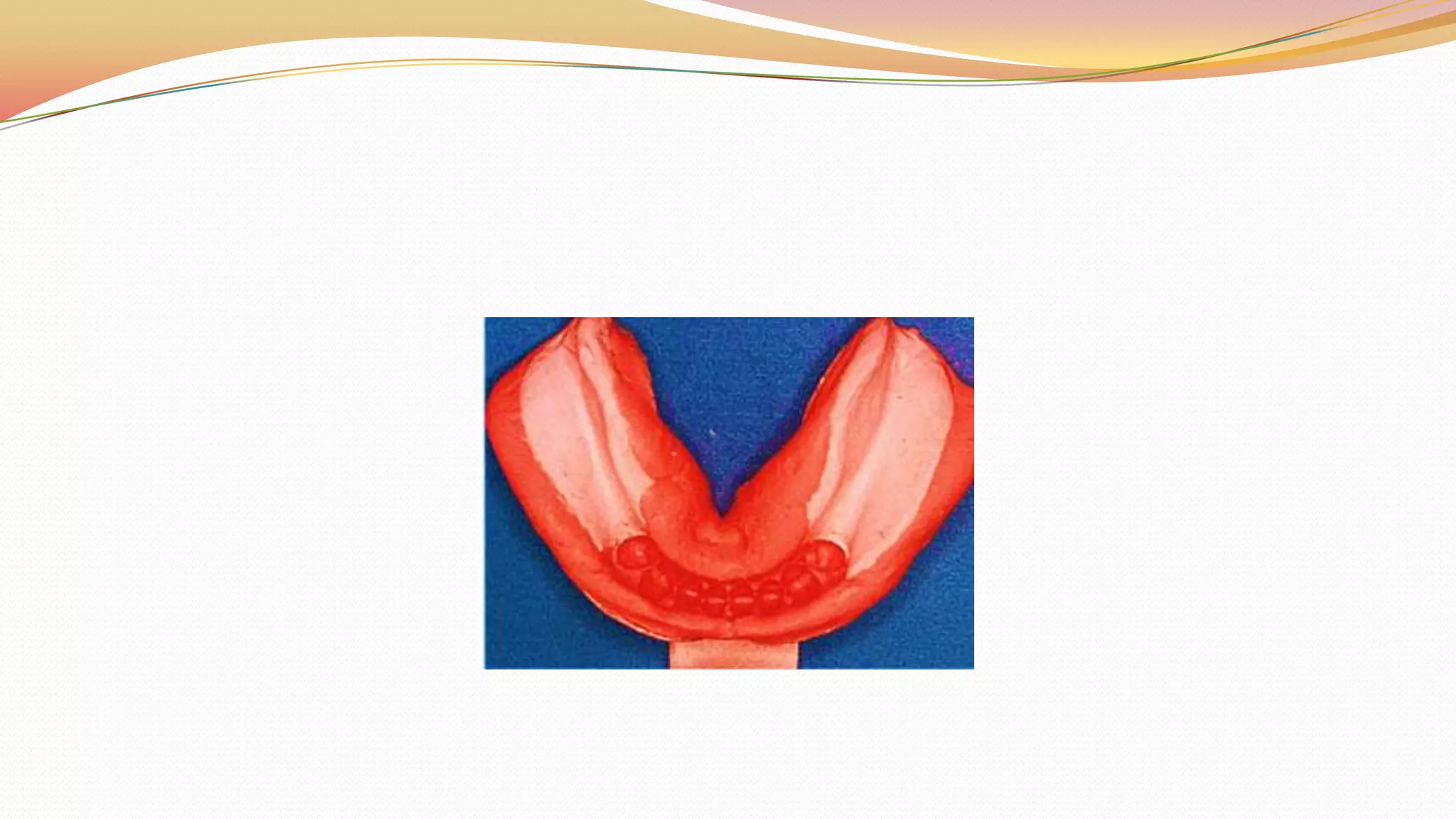Impression procedures for removable partial denture | PPTX