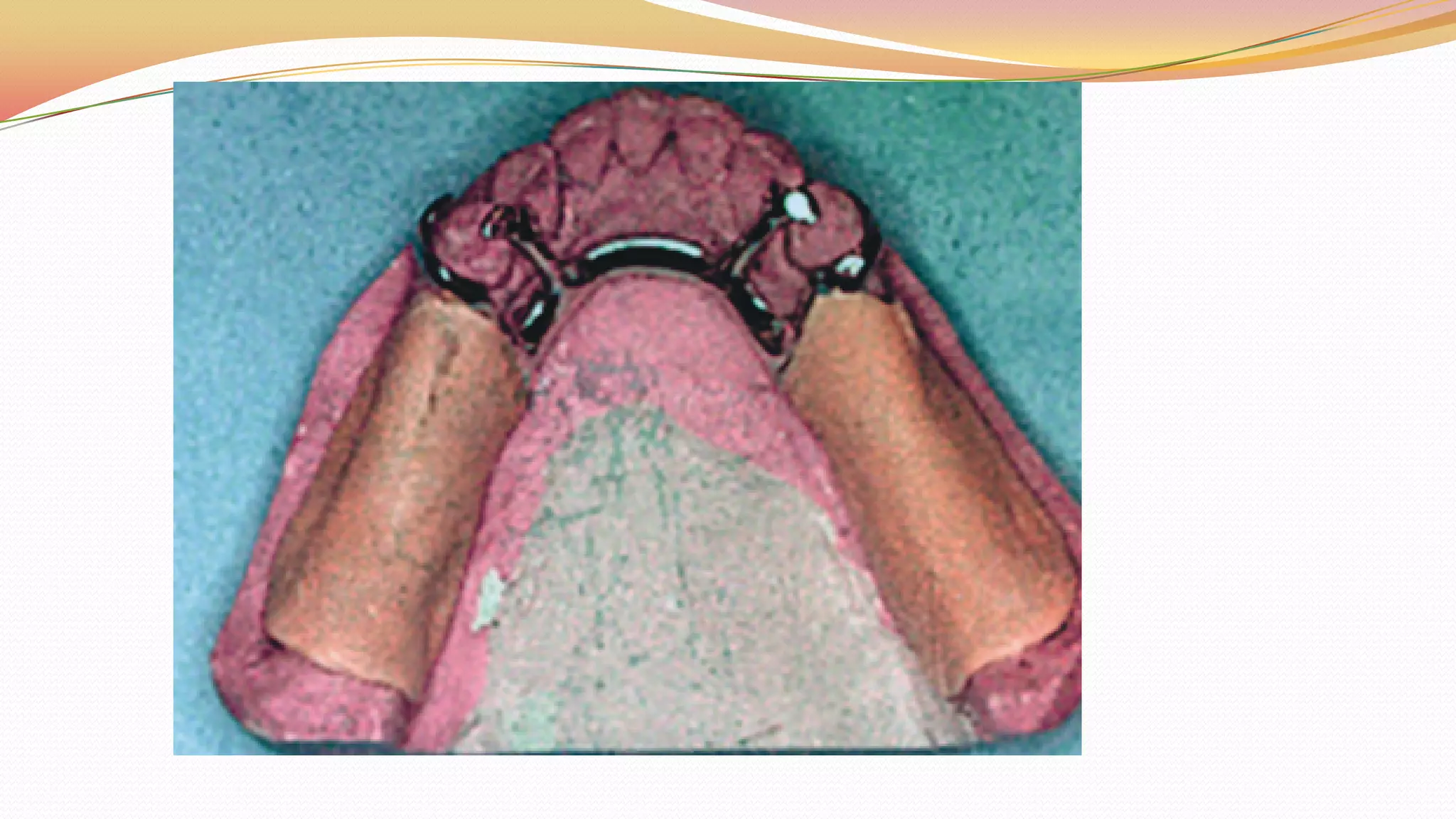 Impression procedures for removable partial denture | PPTX