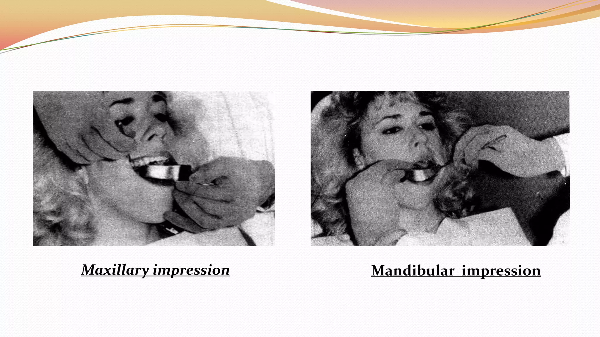 Impression procedures for removable partial denture | PPTX