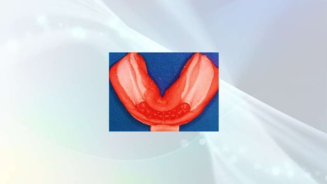 Impression - RPD | PPTX | Oral care | Personal Care