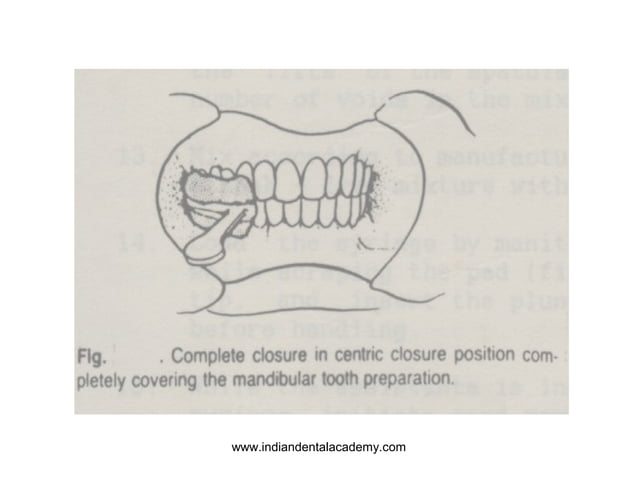 Impressions for fpd/ implant dentistry course | PPT