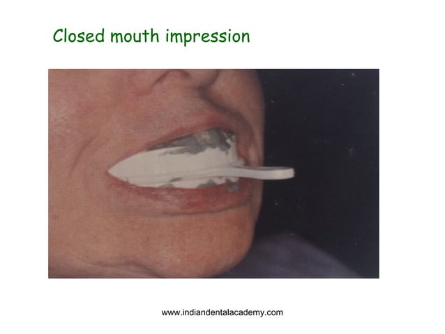 Impressions for fpd/ implant dentistry course | PPT