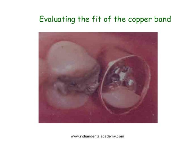Impressions for fpd/ implant dentistry course