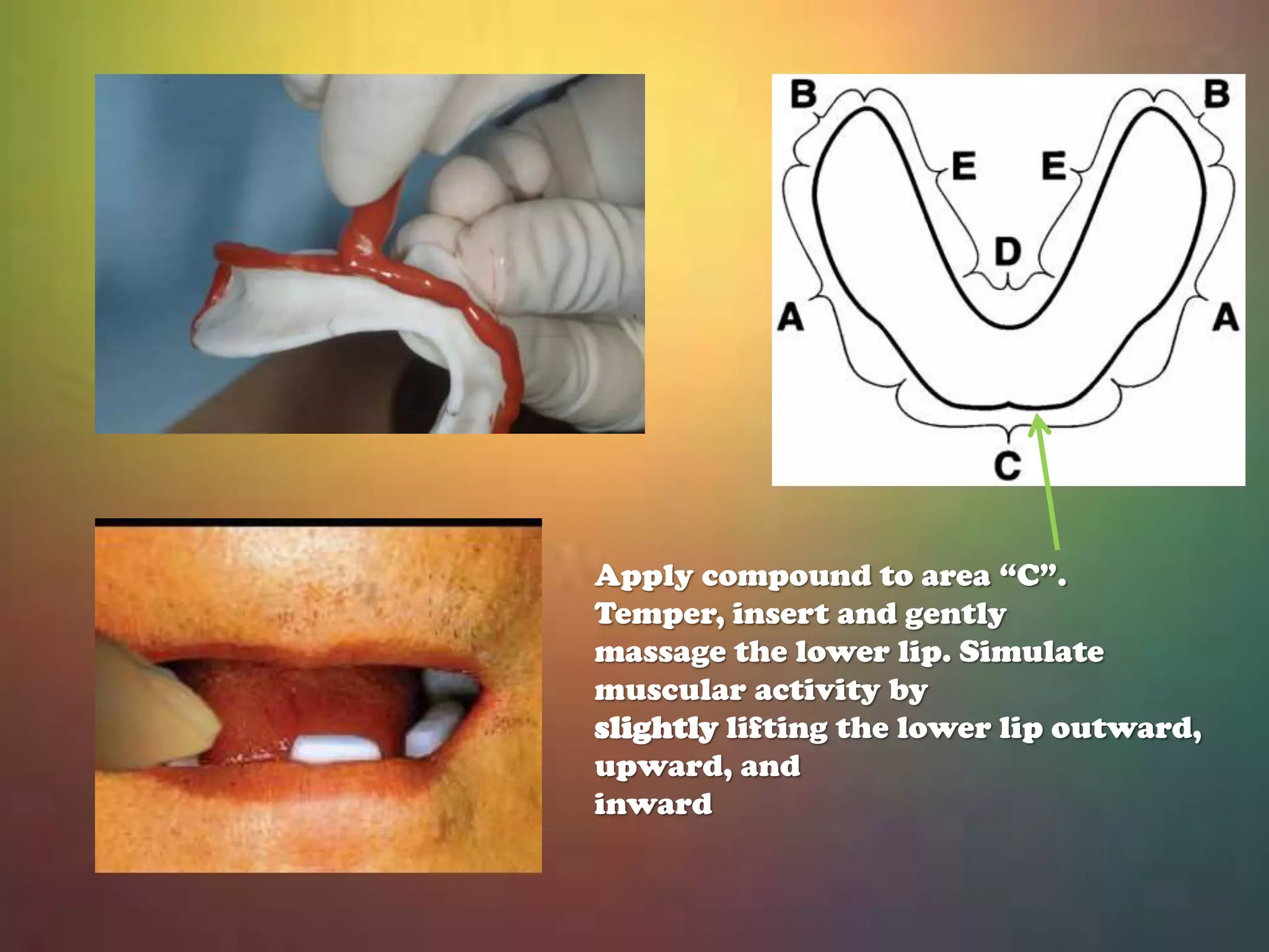 Impressions in complete dentures | PPTX