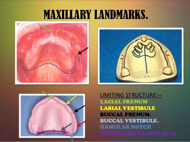 Maxillary Labial Vestibule Nasopalatine Duct Cyst Associated With
