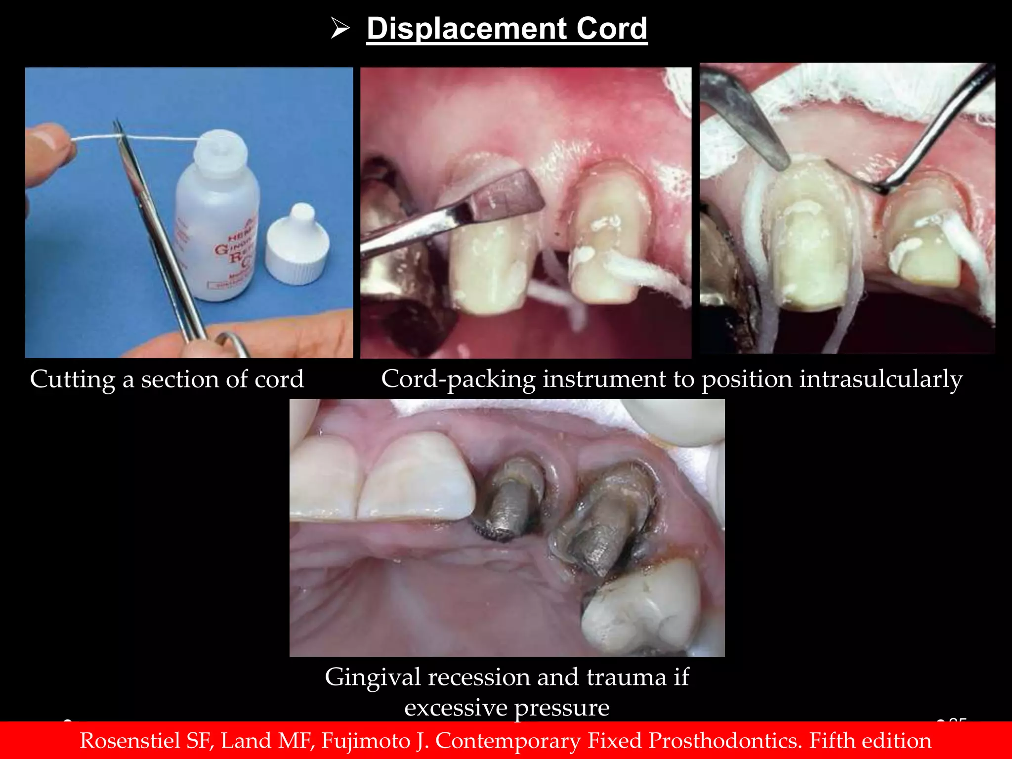 Impressions in fixed partial denture | PPTX