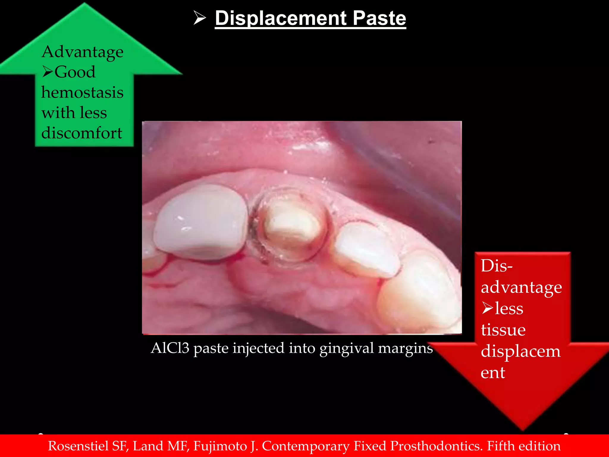 Impressions in fixed partial denture | PPTX