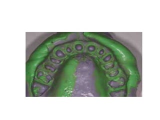 Impressions in fpd | PPT