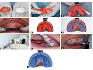 Impressions in fpd | PPT
