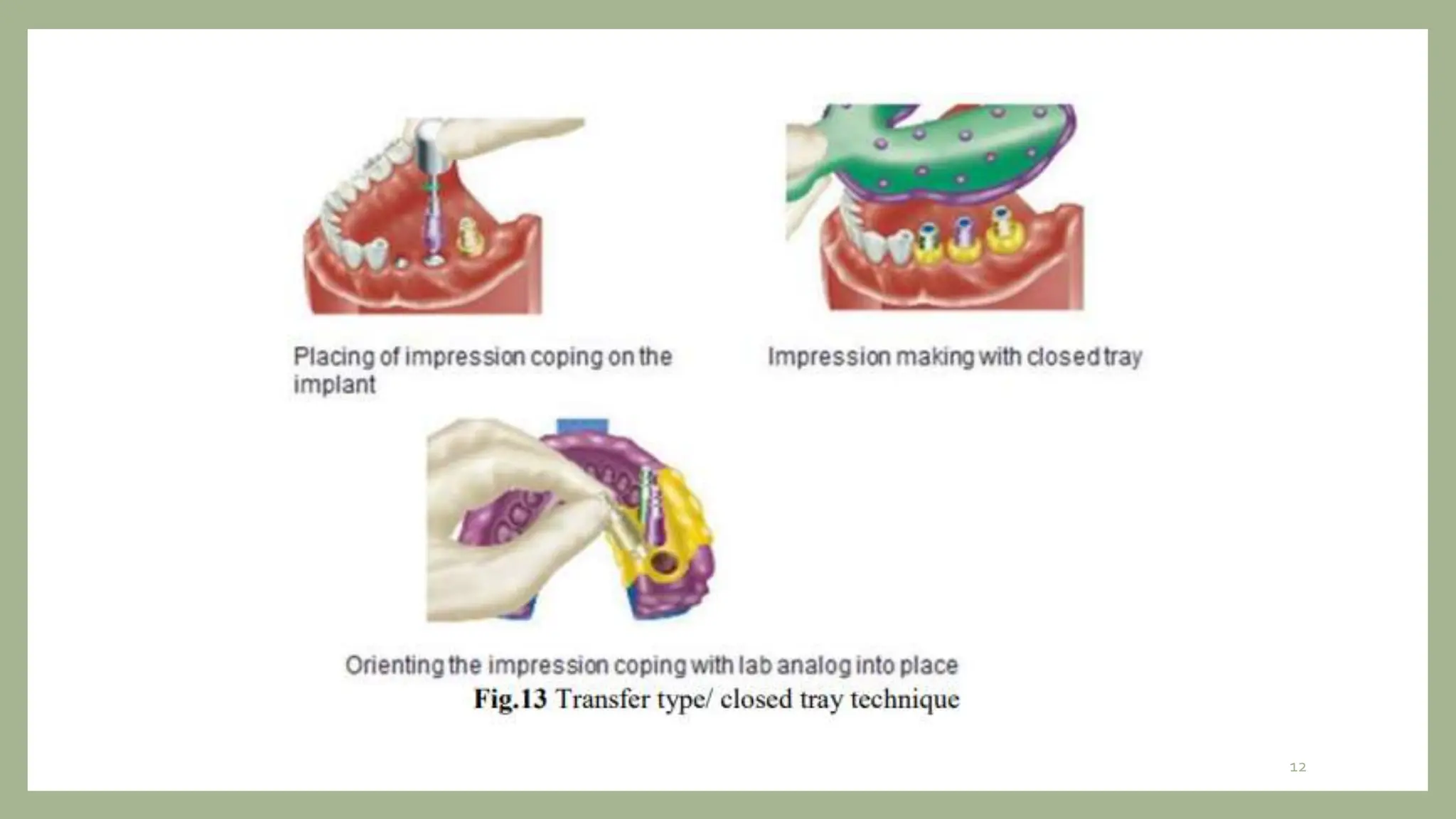 impressions in implants.pptx
