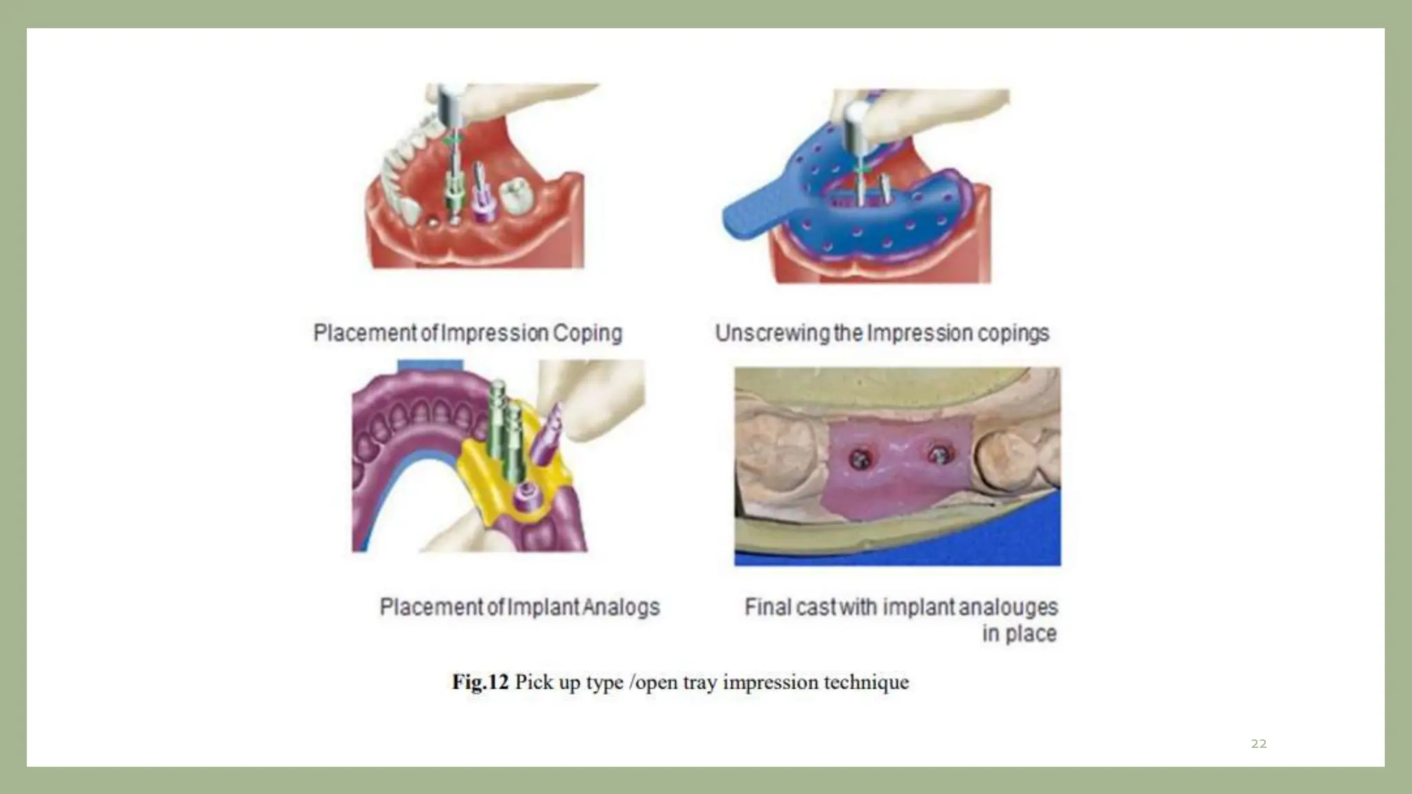 impressions in implants.pptx