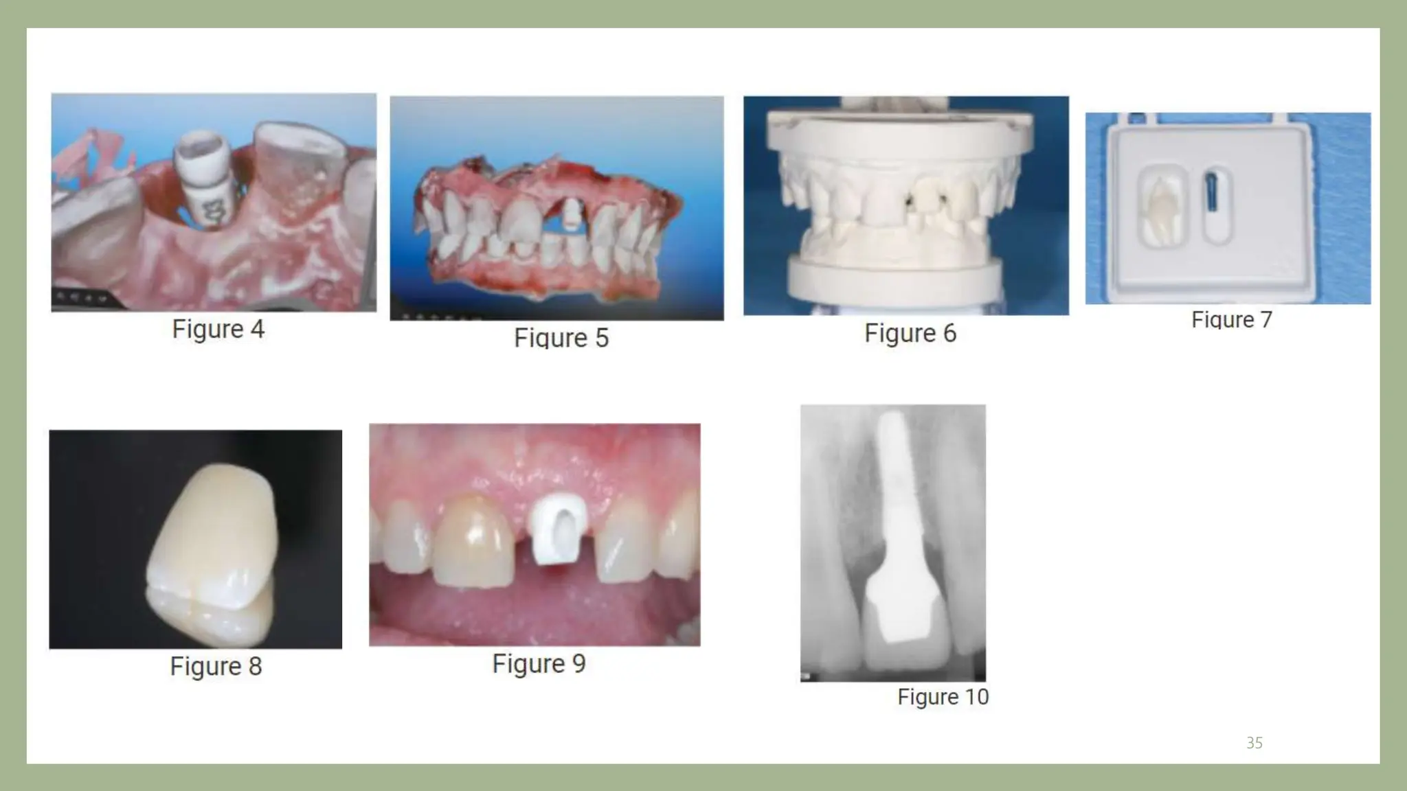 impressions in implants.pptx