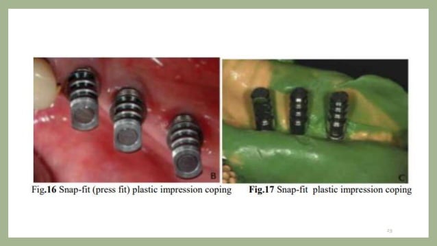 impressions in implants.pptx