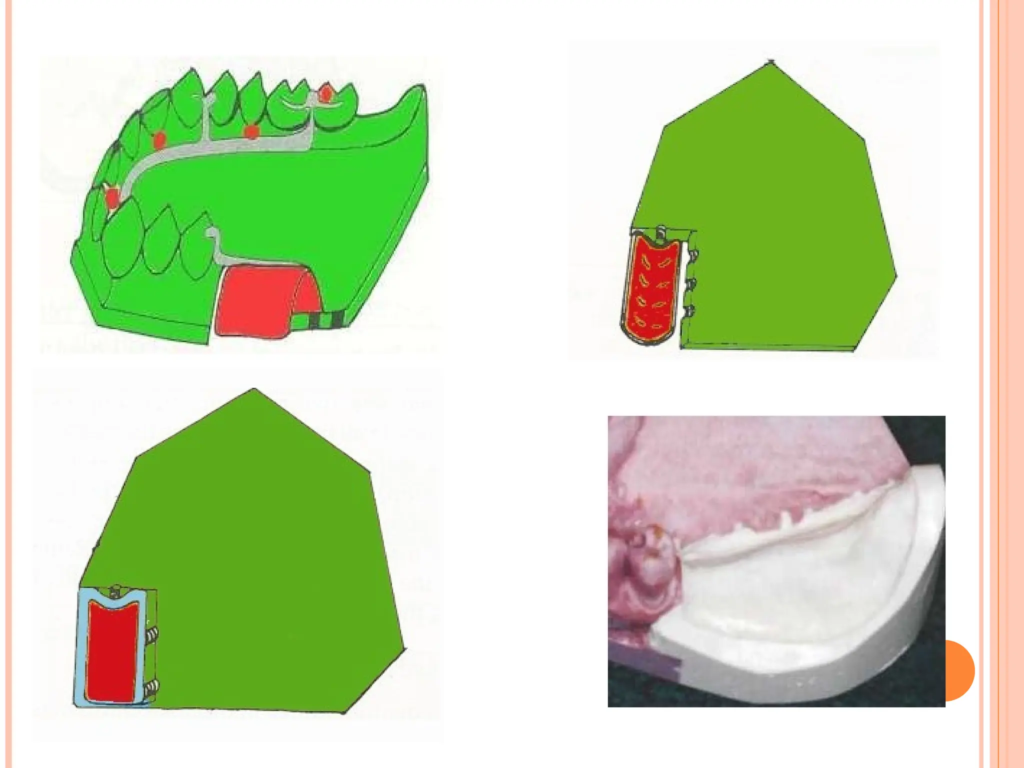 IMPRESSIONS IN RPD.pptnm, mnjkl,.jkokjnjkkj | PPT