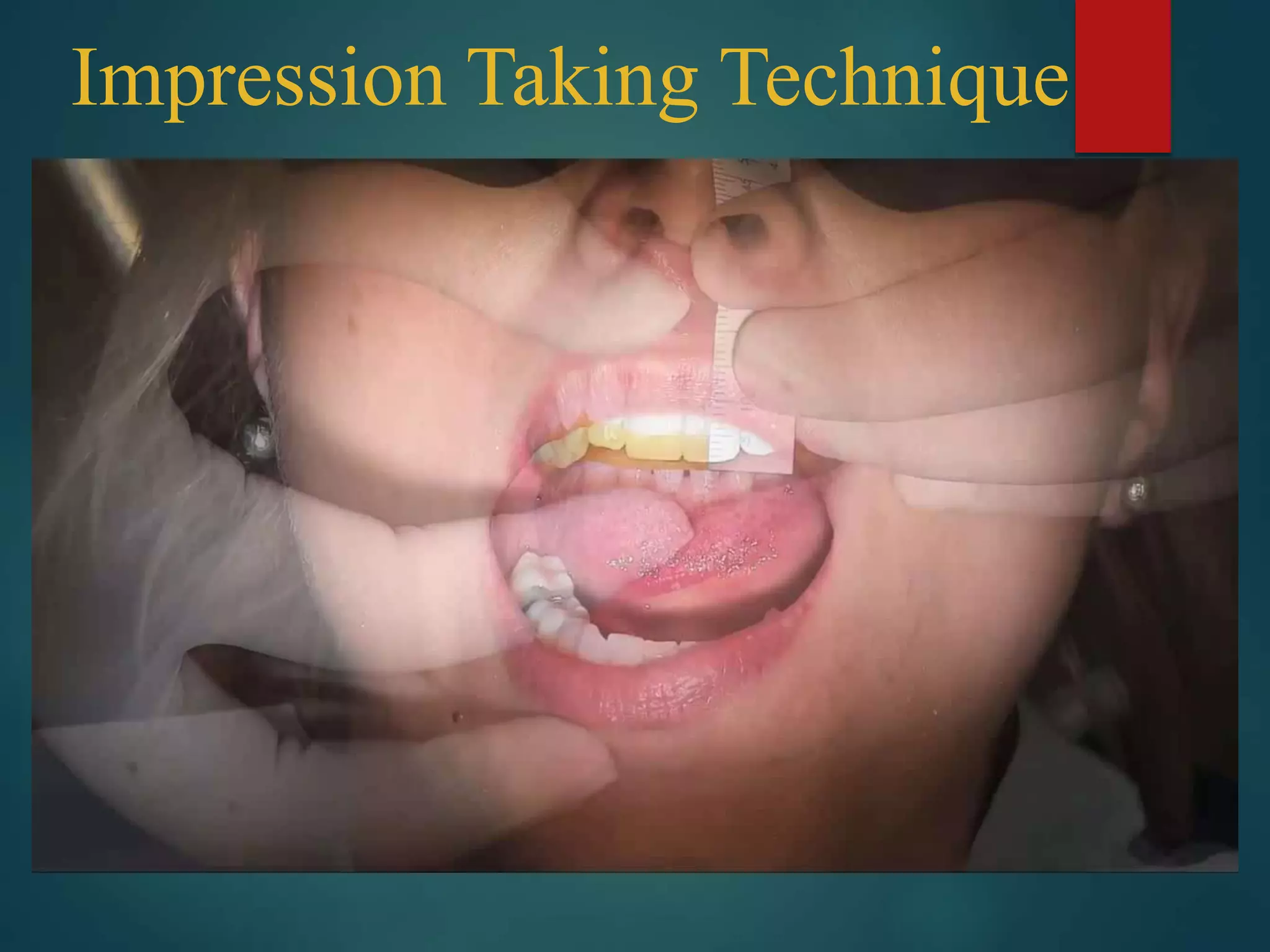 Impression Taking By Alginate | PPTX