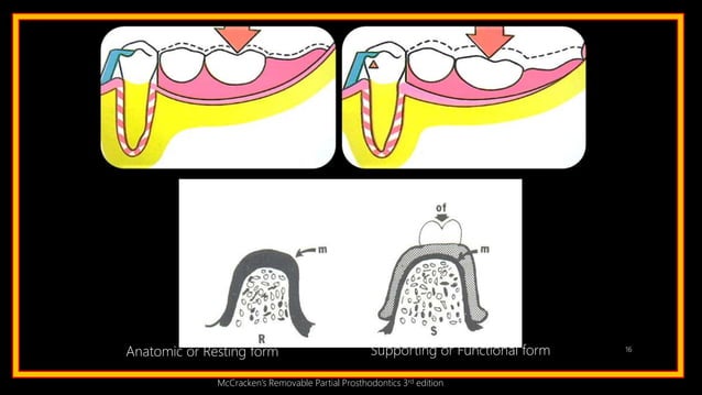 Impression techniques in rpd | PPTX