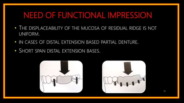 Impression techniques in rpd | PPTX