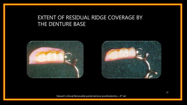 Impression techniques in rpd | PPTX