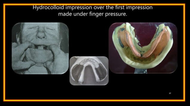 Impression techniques in rpd | PPTX