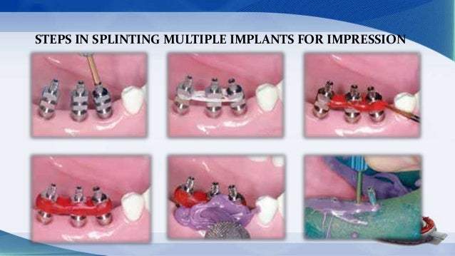 Impression techniques