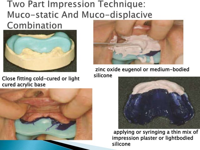 Impression techniques in complete denture | PPTX