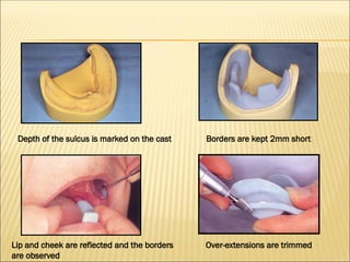 Impression techniques in complete dentures.ppt