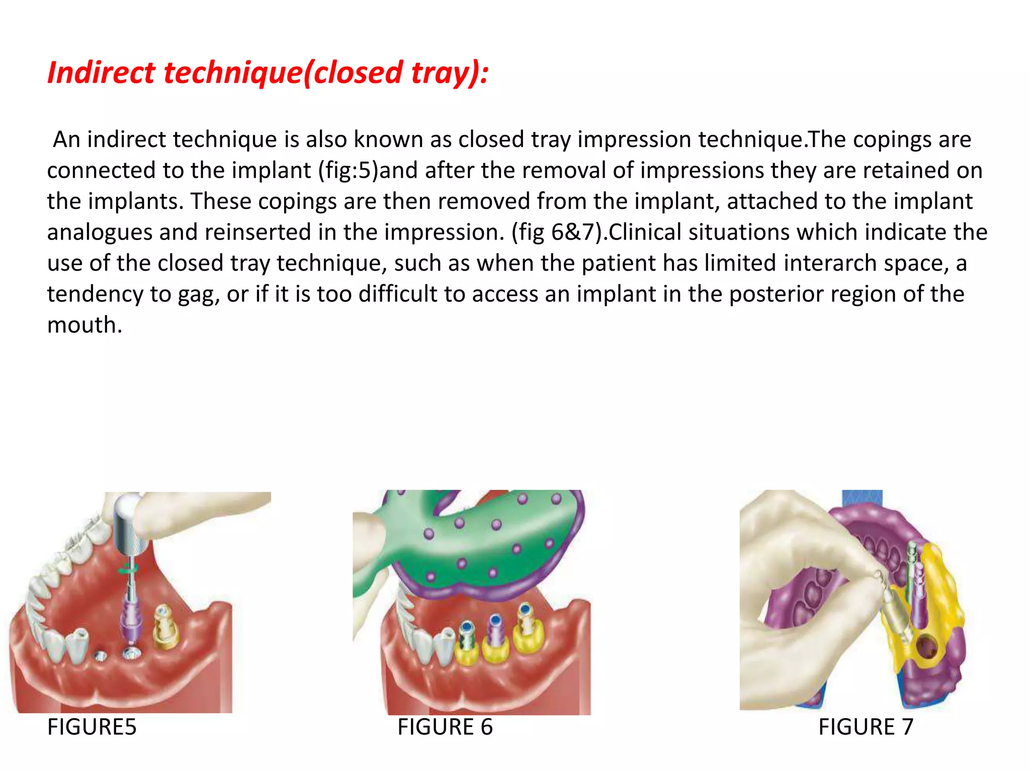 Impression techniques in implants | PPTX