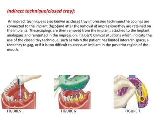 Impression techniques in implants | PPTX