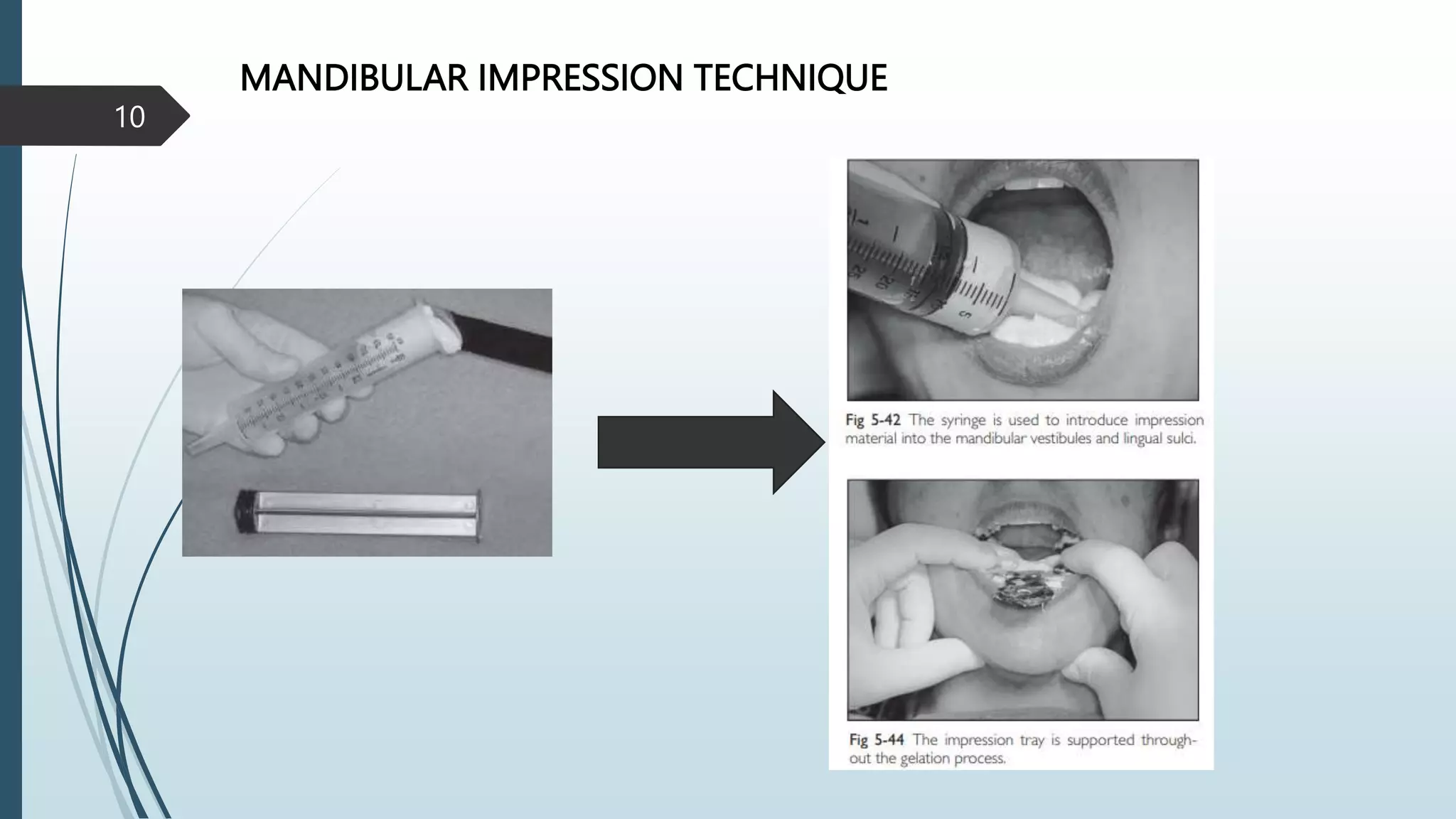 Impression techniques in Removable partial denture.pptx