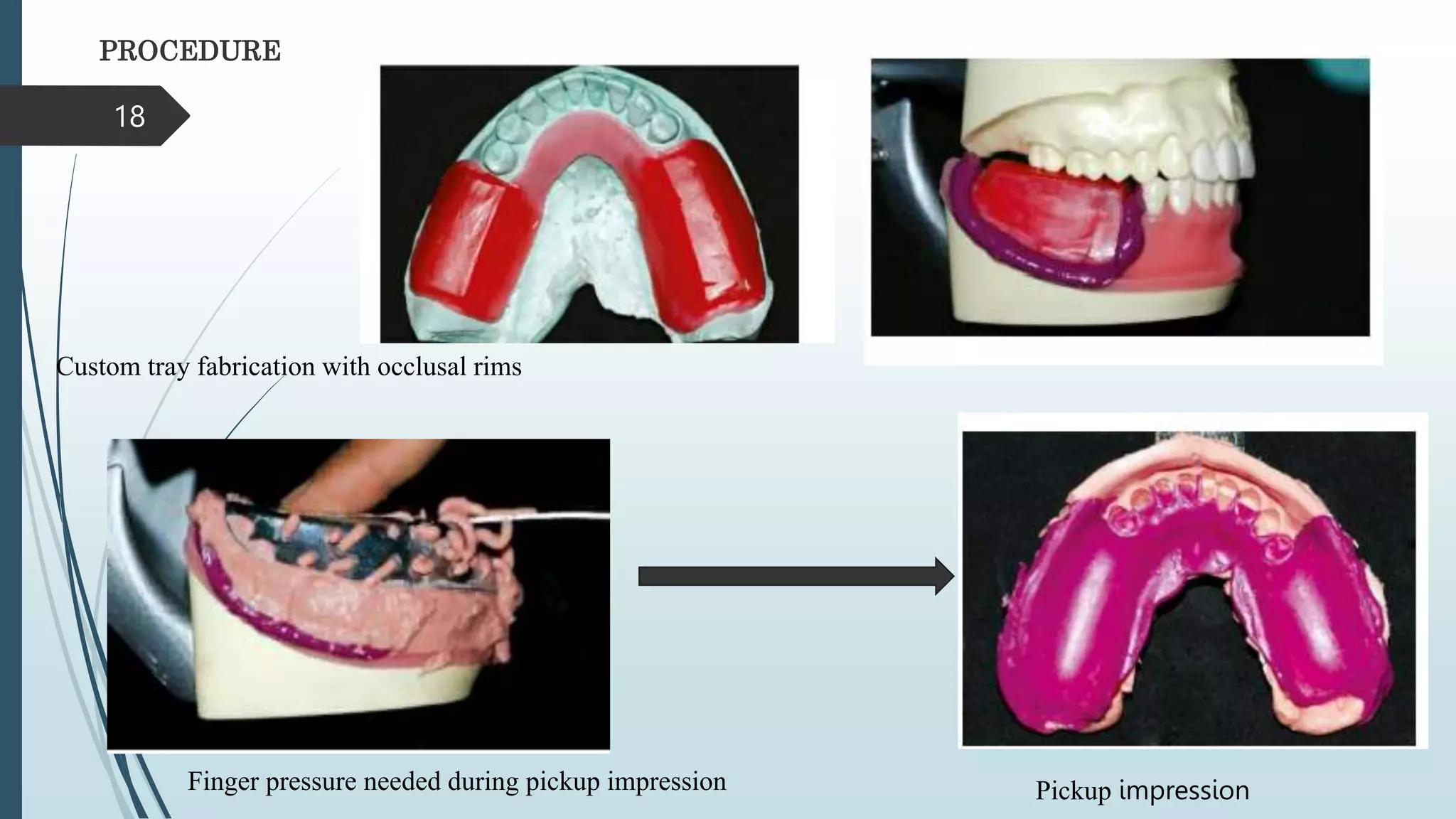 Impression techniques in Removable partial denture.pptx