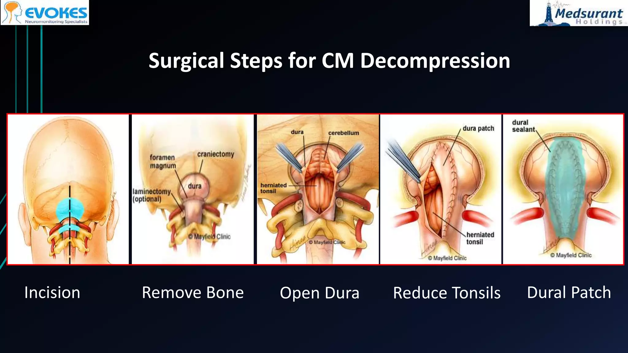 Improved transcranial motor evoked potentials after craniovertebral ...