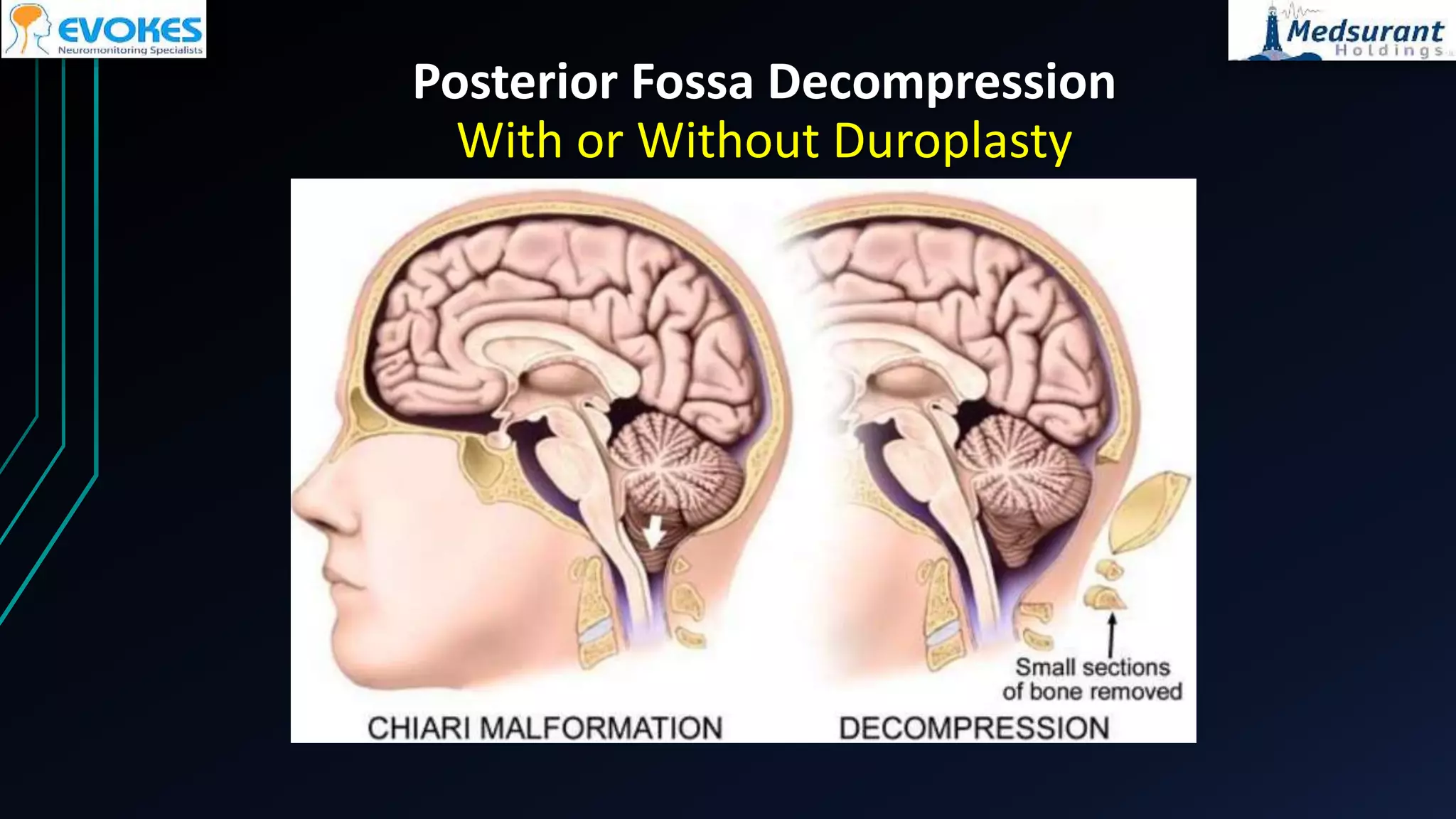 Improved transcranial motor evoked potentials after craniovertebral ...