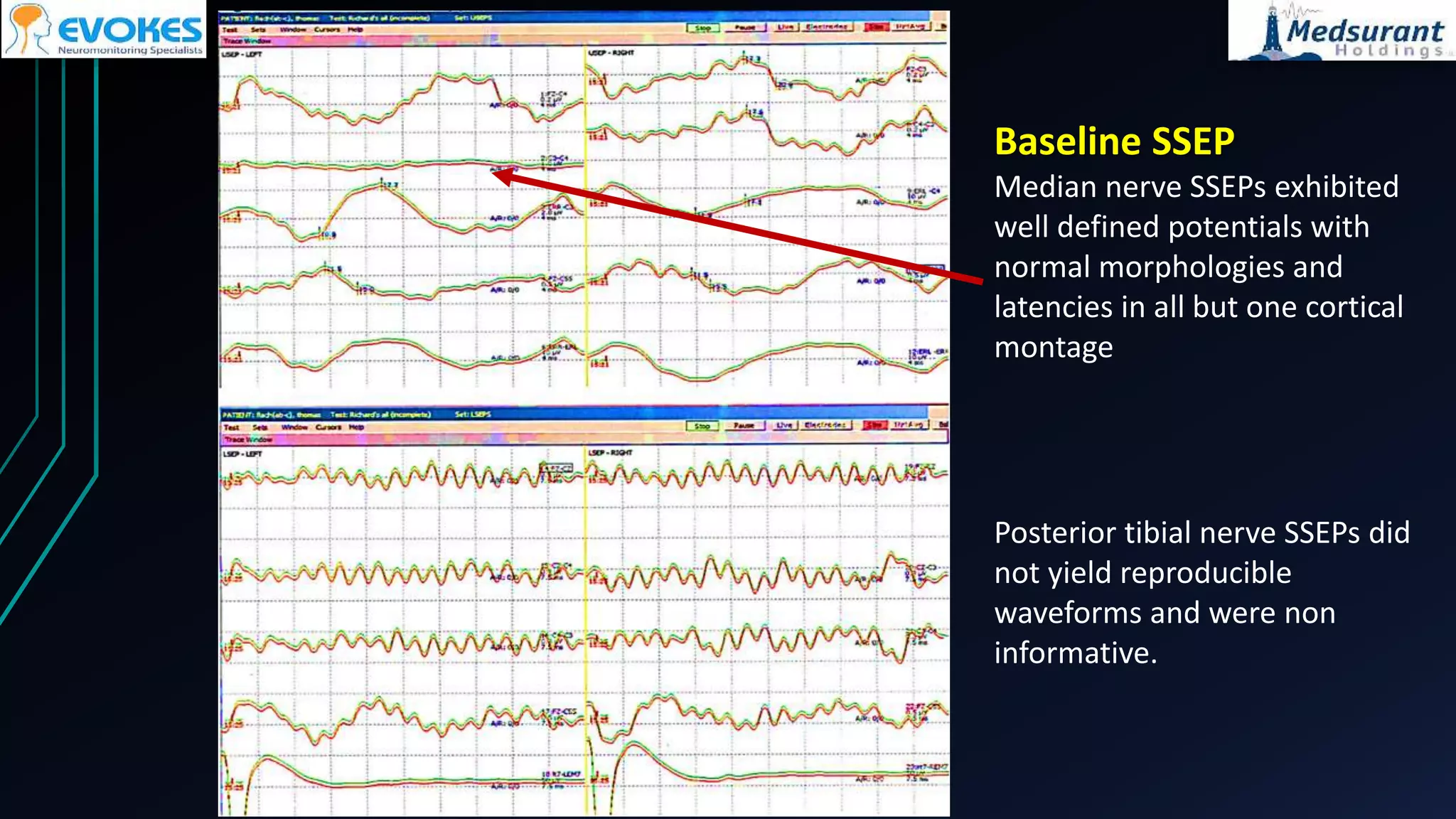 Improved transcranial motor evoked potentials after craniovertebral ...