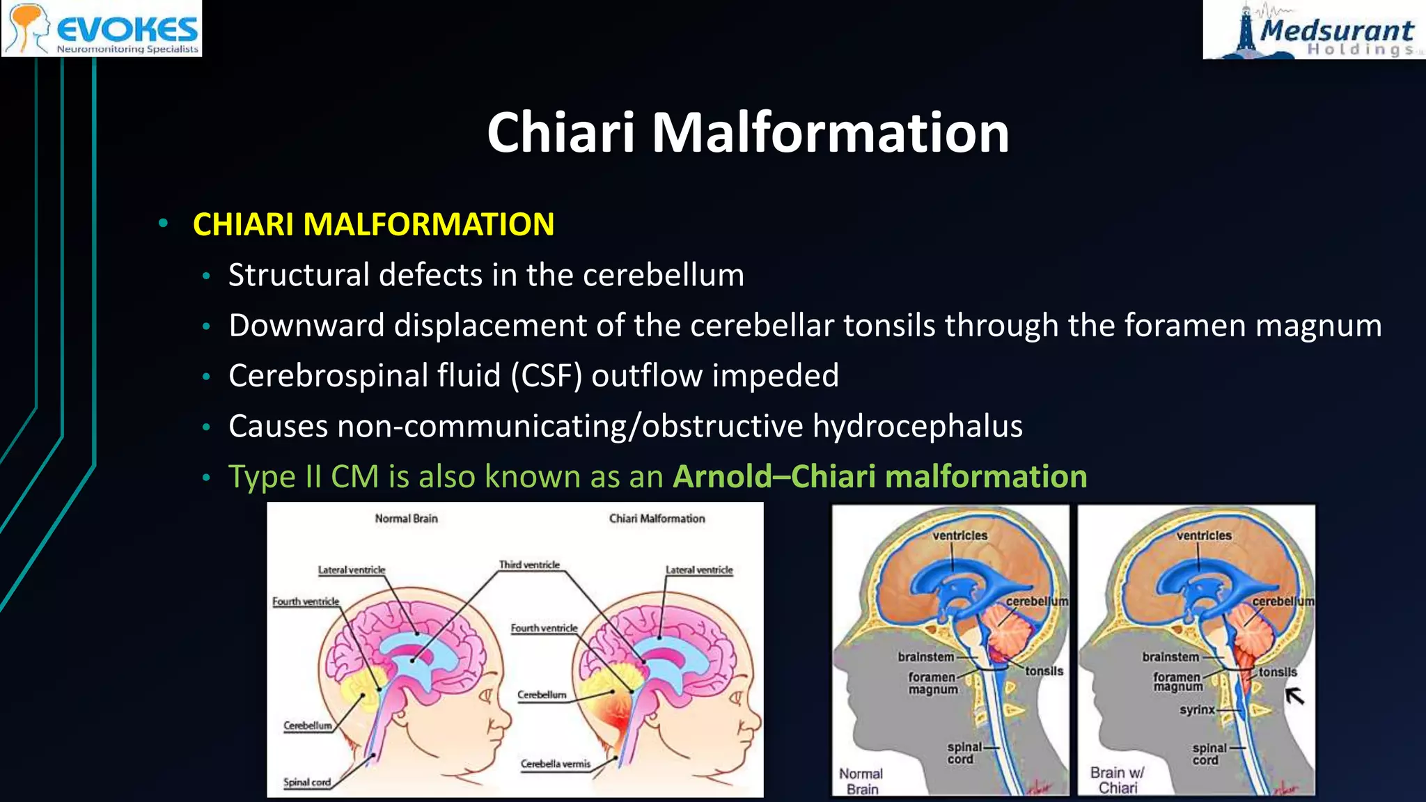 Improved transcranial motor evoked potentials after craniovertebral ...