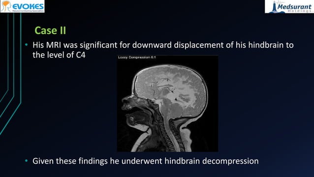 Improved transcranial motor evoked potentials after craniovertebral ...