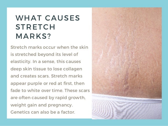 Improving Red and White Stretch Marks With Laser Treatments
