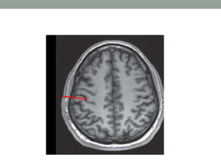 frontal lobe anatomy and clinical relevance | PPT