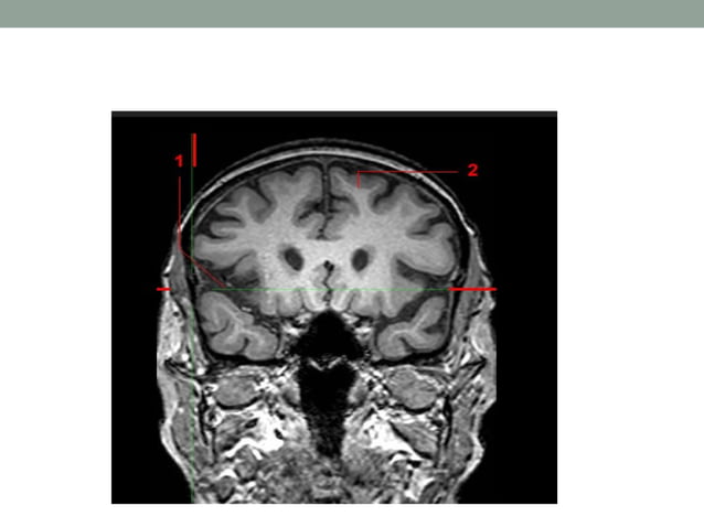frontal lobe anatomy and clinical relevance | PPT