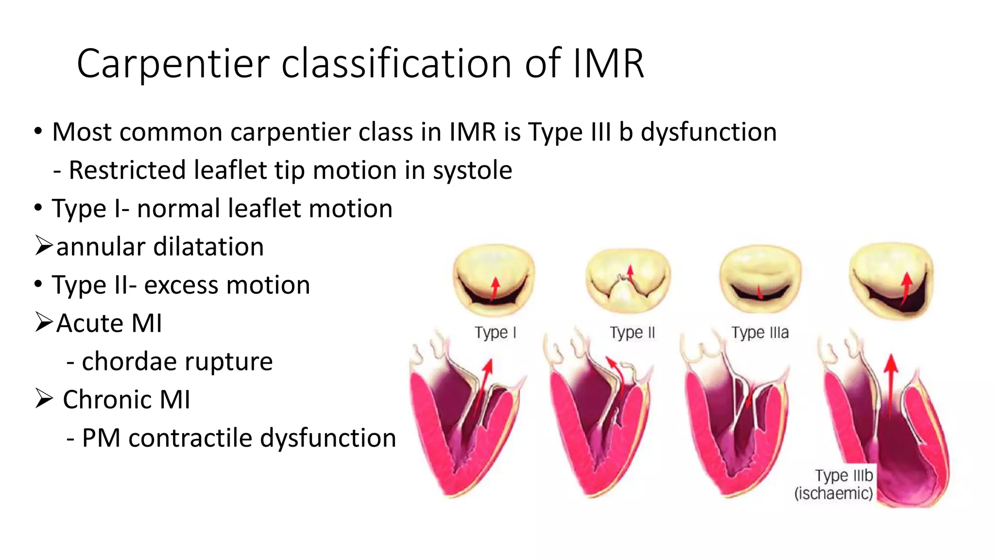 ishemic mitral regurgitation gopan Amrita hospital | PPTX