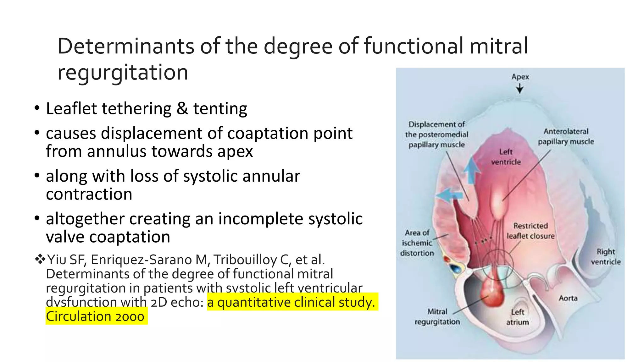 ishemic mitral regurgitation gopan Amrita hospital | PPTX