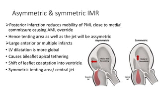 ishemic mitral regurgitation gopan Amrita hospital | PPTX