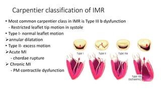 ishemic mitral regurgitation gopan Amrita hospital | PPTX