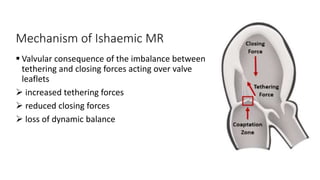 ishemic mitral regurgitation gopan Amrita hospital | PPTX